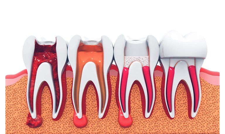 Gum Infection Post-Root Canal: What to Know