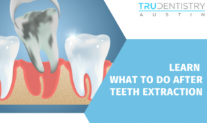 Do And Don'ts Before And After Tooth Extraction?