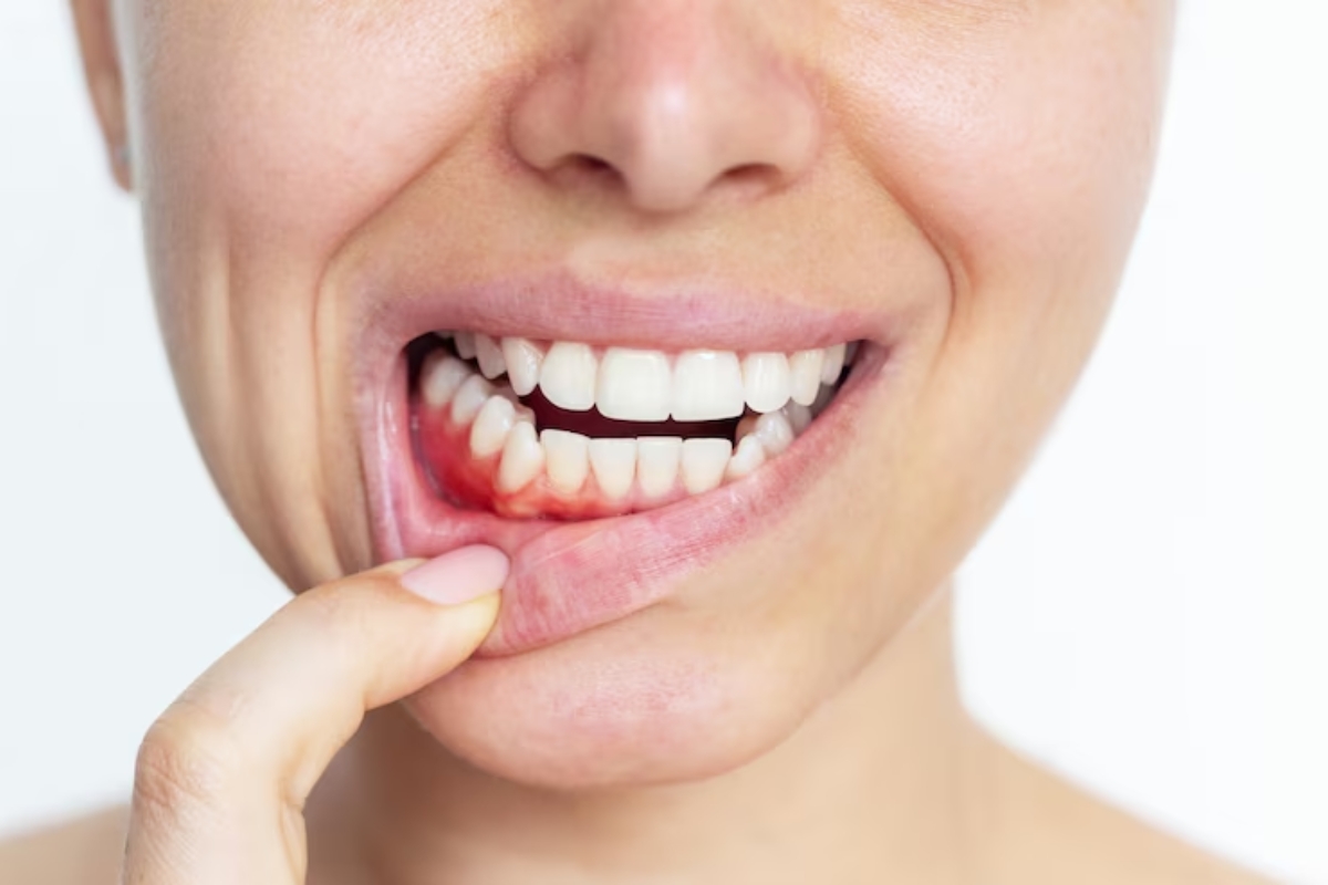 White Gums: Causes and Symptoms